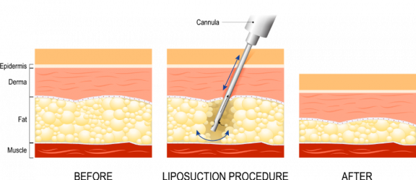 Love Handles Liposuction Sydney - $30/Week Per Area