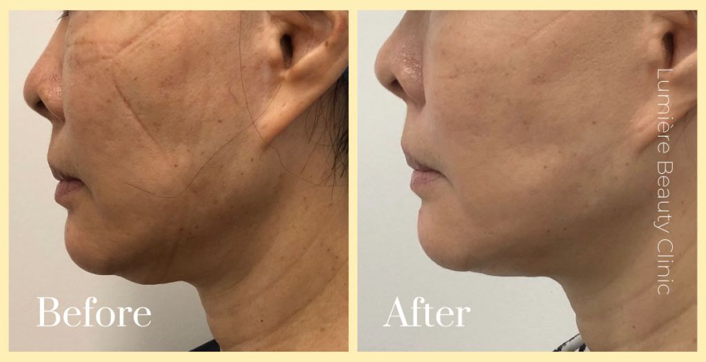 FaceTite & BodyTite Sydney From $30/Week from Lumiere Clinic