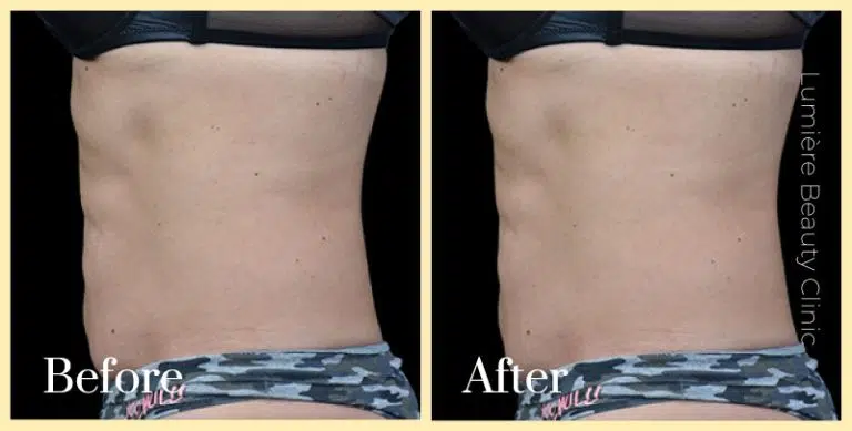 EMSCULPT Body Sculpting Sydney - $30/Week - Lumiere Clinic