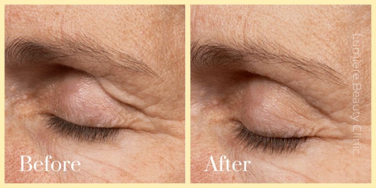 Expert Thermage Skin Tightening in Sydney | Lumière Clinic