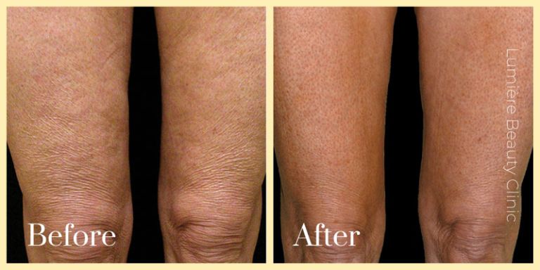 Expert Thermage Skin Tightening in Sydney | Lumière Clinic