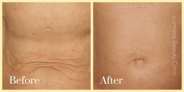 Expert Thermage Skin Tightening in Sydney | Lumière Clinic