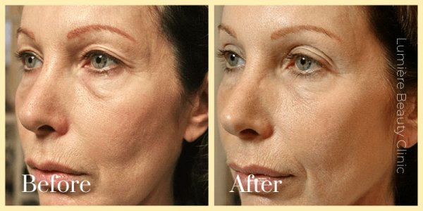 Expert Thermage Skin Tightening in Sydney | Lumière Clinic