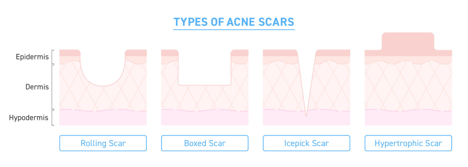 Laser Scar Removal in Sydney for Clear, Luminous Skin | Lumière Clinic