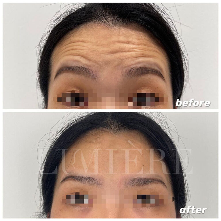 How to Get Rid of Forehead Lines | Lumière Clinic Sydney